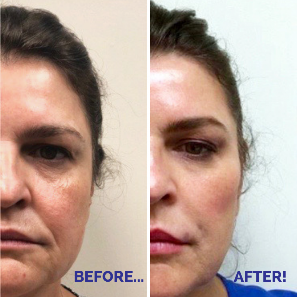 Best JUVÉDERM® Voluma Treatment in Dallas, TX (Preston Hollow) Near Me